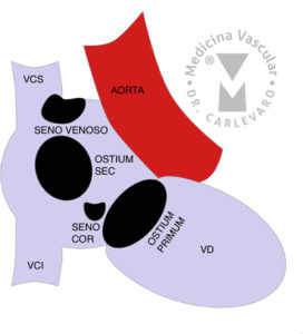 CIA, CIV y Ductus Arterioso por cateterismo - Medicina Vascular