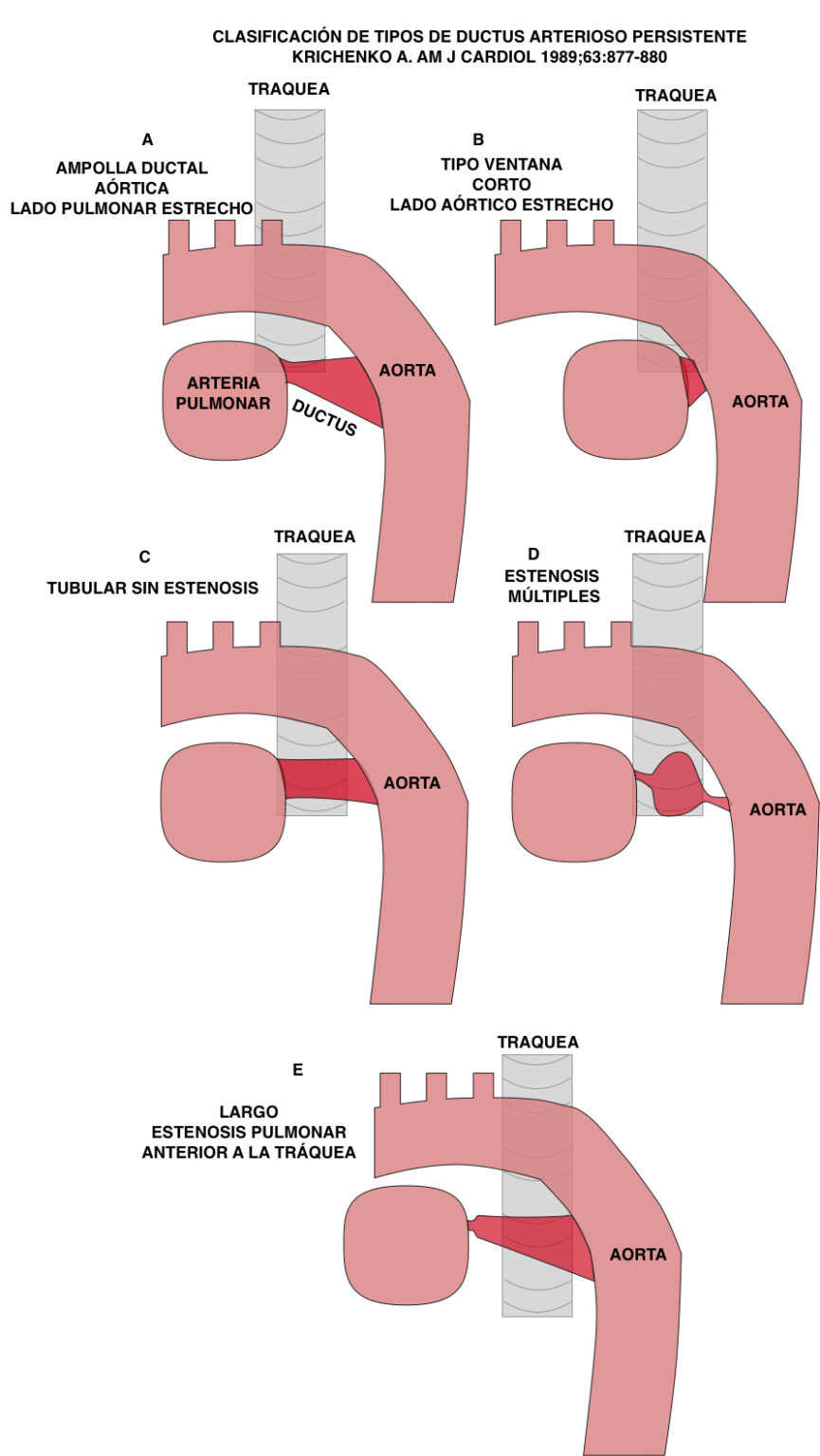 Ductus Arterioso Persistente - Medicina Vascular